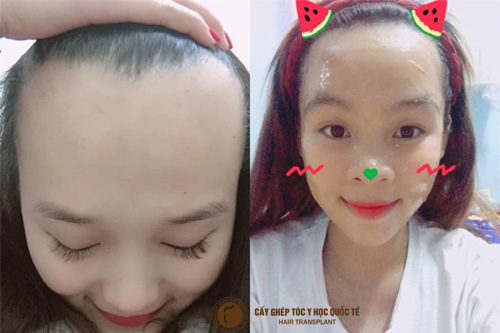 Trán cao đâu phải chuyện to tát, đã có cấy tóc tự thân lo! - Cấy Ghép ...